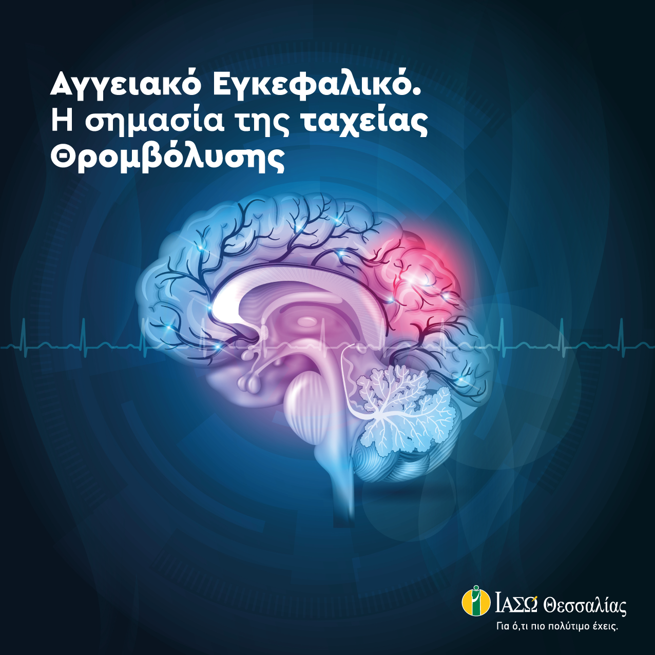 ΙΑΣΩ Θεσσαλίας: Αγγειακό Εγκεφαλικό Επεισόδιο - Η σημασία της ταχείας ...